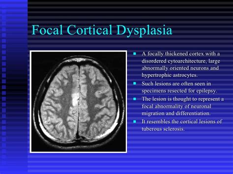 What Is Cortical Dysplasia Epilepsyu