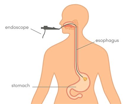 Whats The Difference Between An Endoscopy Colonoscopy And
