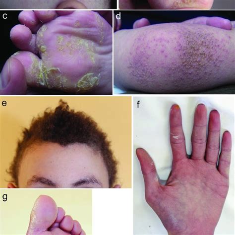 Pdf Desmoplakin Mutations With Palmoplantar Keratoderma Woolly Hair