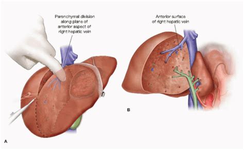 Left Hepatic Trisectionectomy Basicmedical Key