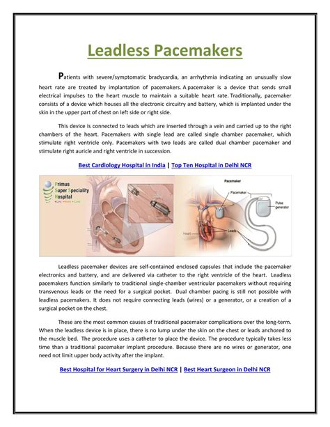 Ppt Leadless Pacemakers Powerpoint Presentation Free Download Id