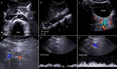 How To Measure Aortomesenteric Angle At Lewis Holt Blog
