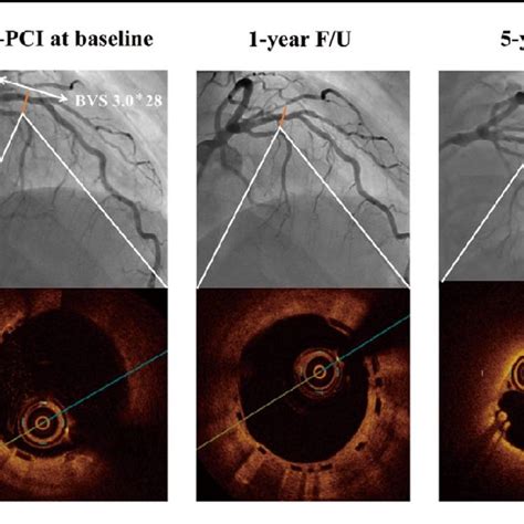 In Scaffold Thin Cap Fibroatheroma Tcfa At 5 Years In A 65 Year Old