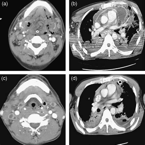 Preoperative Computed Tomography Scan Case 10 In Table 3 Showing Download Scientific Diagram
