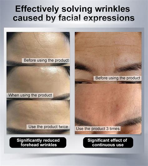 How To Get Rid Of Fine Lines On Forehead Price
