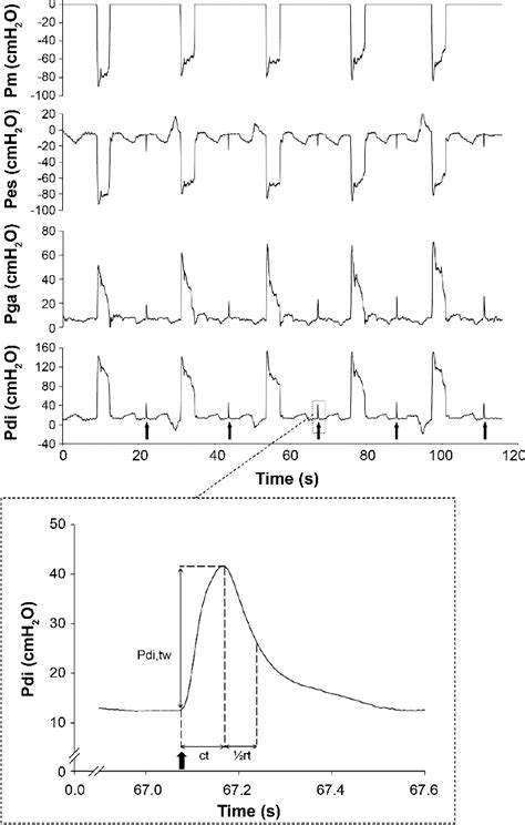 Figure 1 From Sex Differences In Exercise Induced Diaphragmatic Fatigue