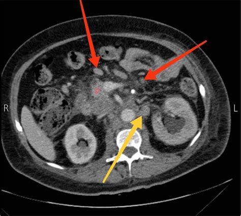 Axial View Ct Scan Showing The Head Of The Pancreas P Enlarged
