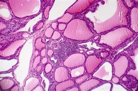Toxic Diffuse Goiter Or Graves Disease Light Micrograph Stock Photo Image Of Anatomy