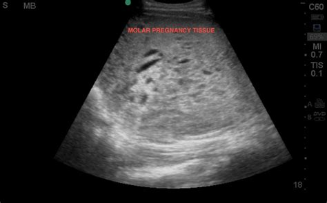 Molar Pregnancy Emory School Of Medicine