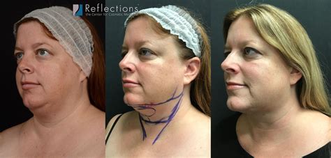 Laser Lipo New Jersey At George Moss Blog