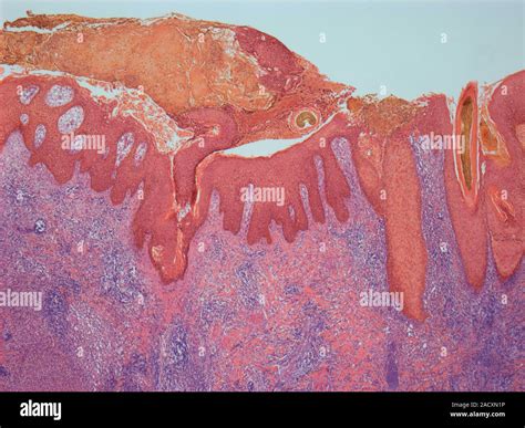 Ringworm Light Micrograph LM Of A Section Of Tinea Capitis Tinea Capitis Is A Fungal