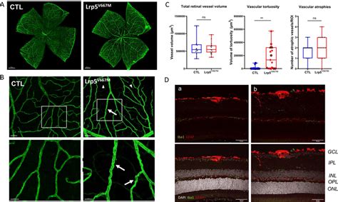 Abnormal Retinal Vessels In Lrp5v667m Mice A Whole‐mounted Retina Of