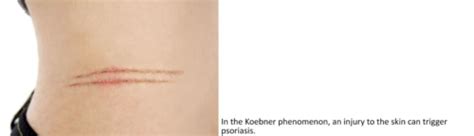 Path Sdl 35 Chronic Inflammatory Dermatoses Test 3 Flashcards