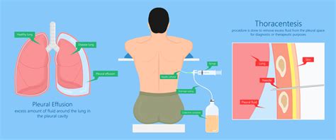 Thoracoscopy Procedure Guidance For Pleural Diseases
