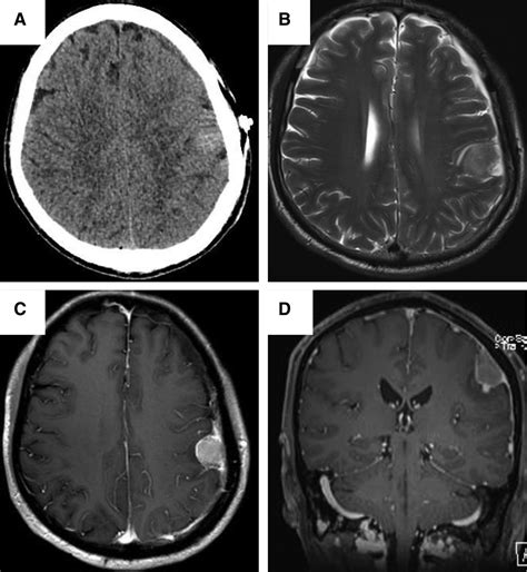 Tumor To Tumor Metastasis A Case Report Of Metastasis Of Na Medicine