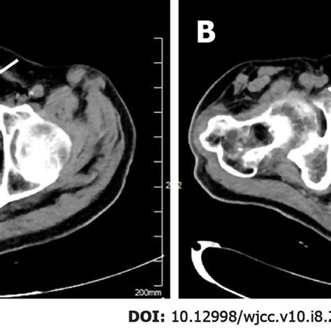 Pelvic Computed Tomography Scan Shows Emphysematous Cystitis Prostate Download Scientific