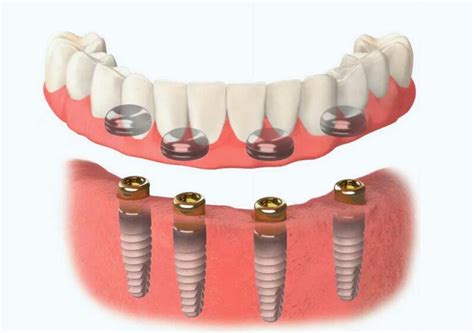 Implant Dentures Stomadent