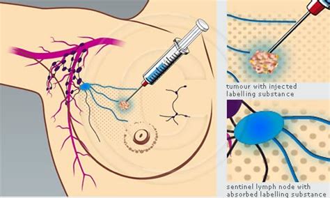 Sentinel Lymph Node Biopsy Location Melanoma Breast Cancer And Removal