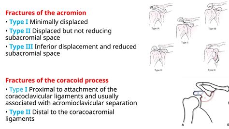 The Fractures Of Clavicle And Scapulapptx