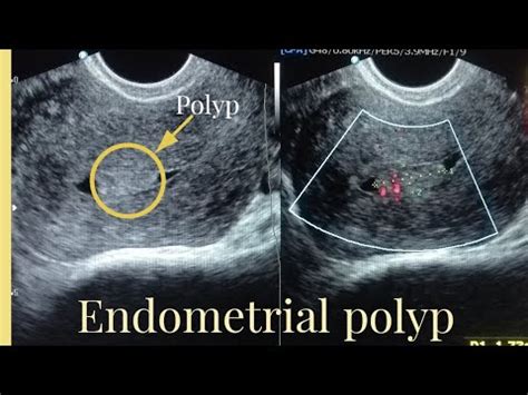Ultrasound Report Of Endometrial Polyp Sonography Of Endometrial Mass