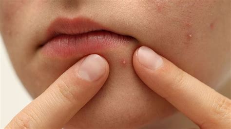 What Causes Pustules Daily Skin Care Routine Homemade Acne