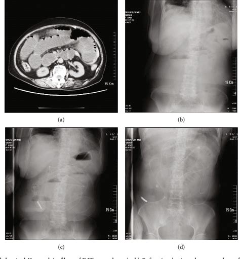 Figure 3 From Short Term Clinical Outcomes After Using Novel Deeper