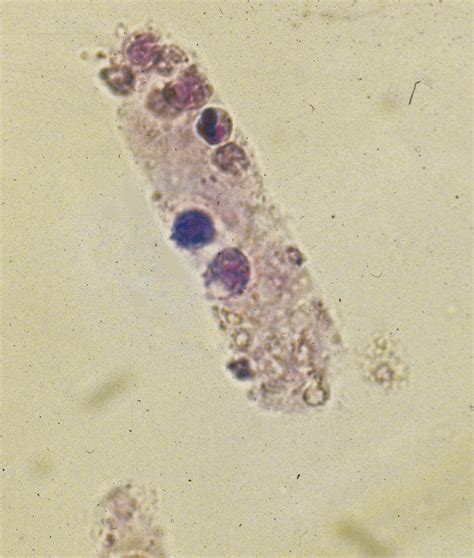 White Blood Cells Casts