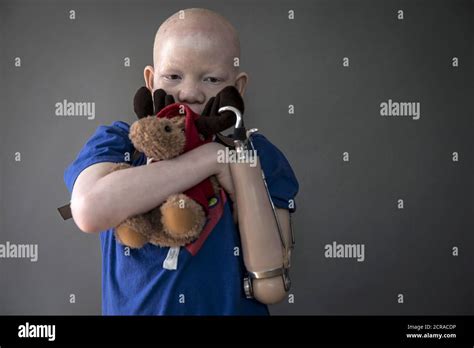 Albino Body Parts Fotos Und Bildmaterial In Hoher Auflösung Alamy