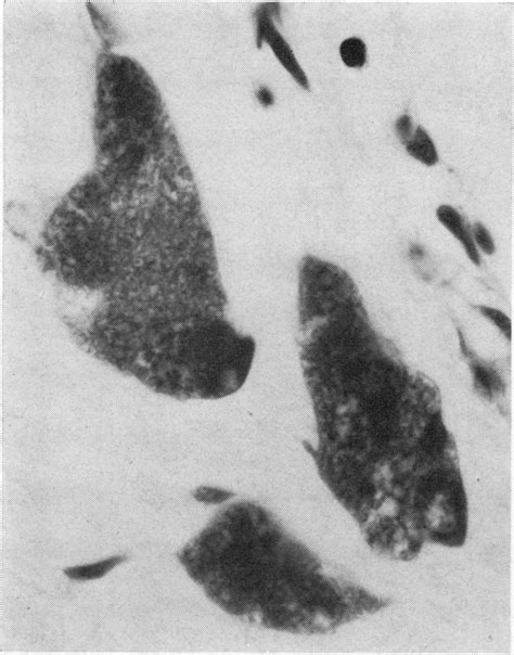 Granular Cell Myoblastoma Suprasternal Fossa Case 7 Small Groups Of