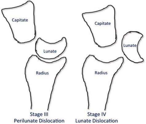 Perilunate Vs Lunate Dislocation