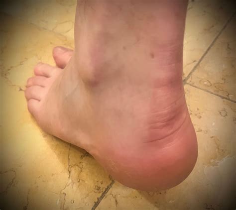 Heel Spurs Bone Spur Surgery Powder Springs Podiatrist Optimum