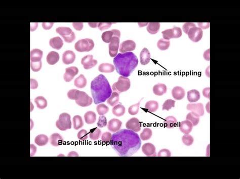 Basophilic Stippling