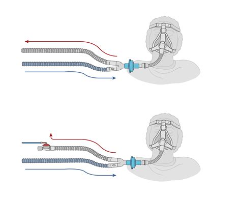 Ventilation Vs Ventilator At Lucy Gardiner Blog