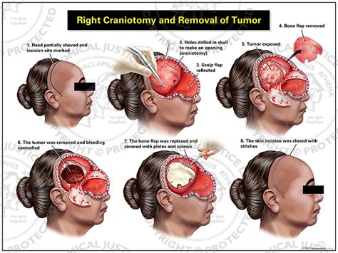 Brain Tumor Removal