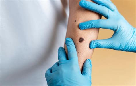 O Que é Um Melanoma Extensivo Superficial