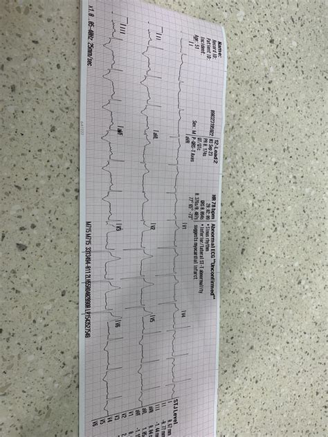 A Flutter Vs Svt Rekgs