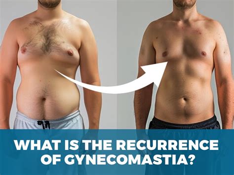 Severe Gynecomastia