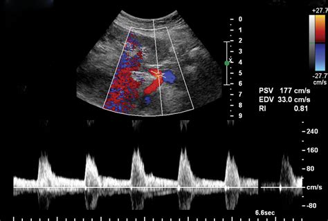 Screening For Transplant Renal Artery Stenosis Ultrasound Based