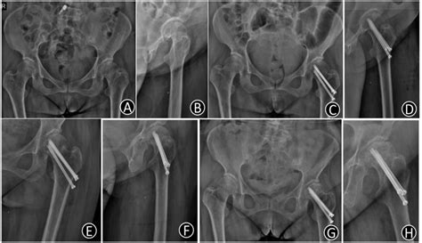 A 65‐year‐old Female Patient Had The Femoral Head Necrosis After