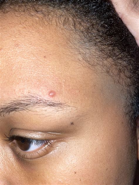 Can Someone Tell Me How To Get Rid Of A Pimple Rpimplecommunity