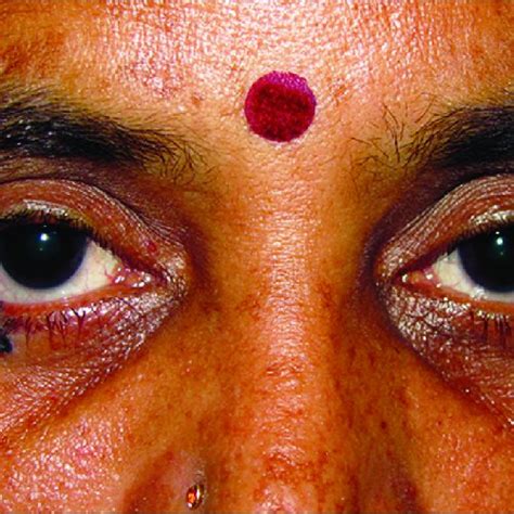 A Preoperative Markings For Wise Pattern Oncoplastic Breast Reduction