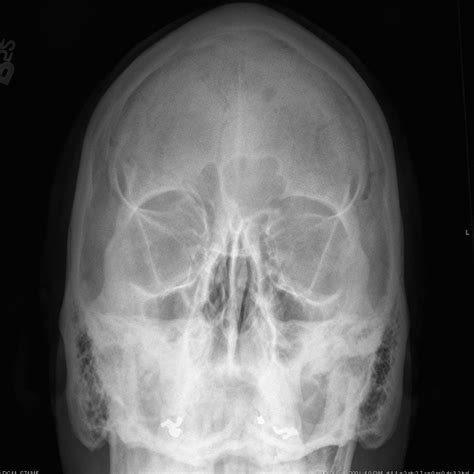 Angled Skull Pa Radiograph Buyxraysonline