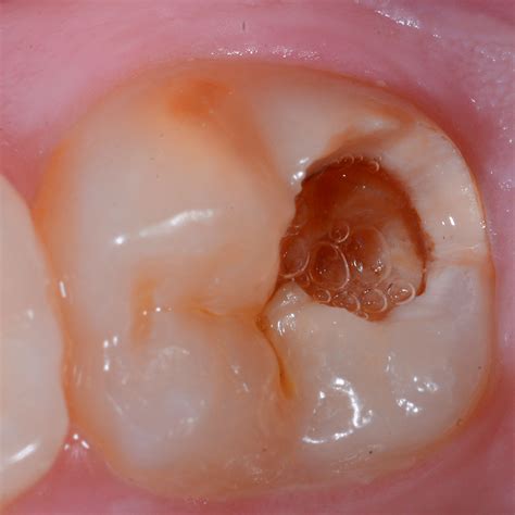 Bioclear Posterior Overlay Vs Filling Bioclear Clinic