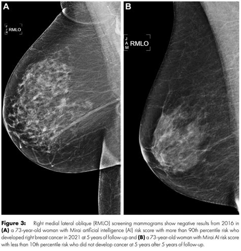 Saima Awan Mba Lssbb On Linkedin Comparison Of Mammography Ai