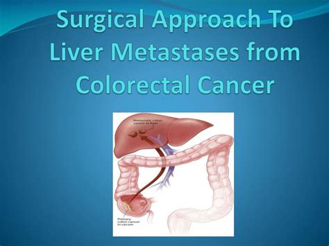 Ppt Surgical Approach To Liver Metastases From Colorectal Cancer Powerpoint Presentation Id