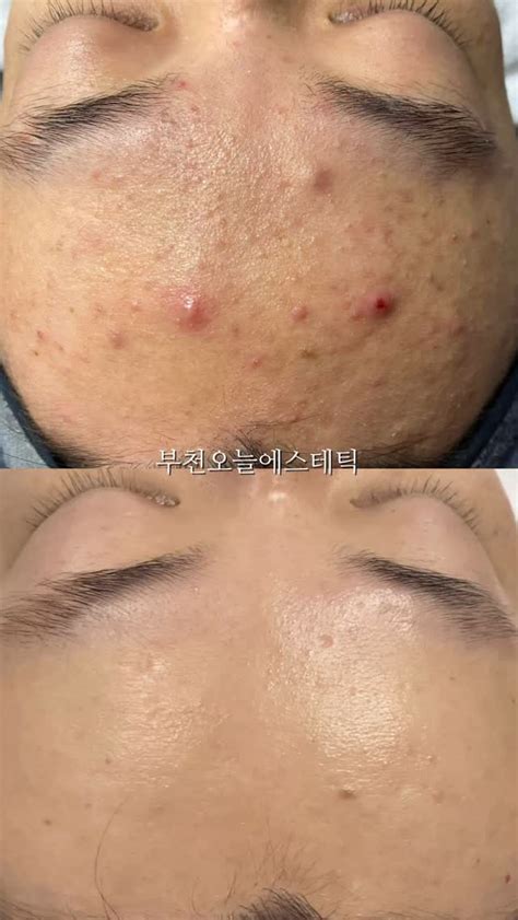 여드름 문제성피부전문 부천오늘에스테틱 성인여드름 압출만으로 깔끔하게 좋아지기 🕶️🖤 피부에 자극이 될 수 있는 필링이나 연고 먹는 약 염증 주사 없이 여드름압출