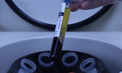 Prp Preparation Procedure Prp Kit Prp Tube Platelet Rich Plasma