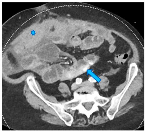 Unravelling Peritoneal Carcinomatosis Using Cross Sectional Imaging