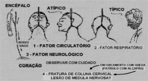 LesÕes Extracervicais Em VÍtimas De Enforcamento DistinÇÃo Entre