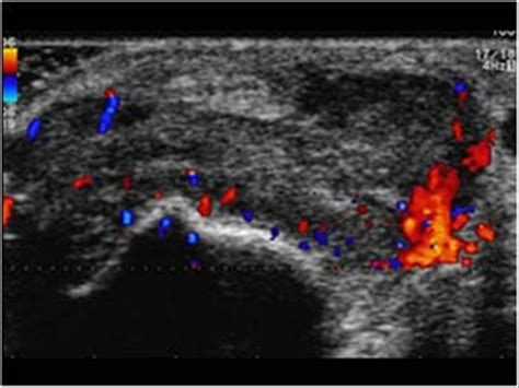 Musculoskeletal Joints And Tendons 6 4 Fingers Case 6 4 3 Arthritis